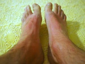 Learn How To Make a Poultice and Use It Properly | All Natural Ideas